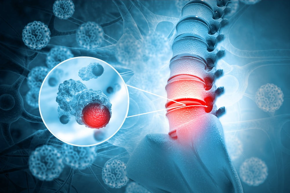 Chordoma Tailbone: Symptoms, Causes and Treatment - Health